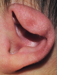 Pediatric Pearls: Infant's Ear - Pits, Tags, and the Pinna