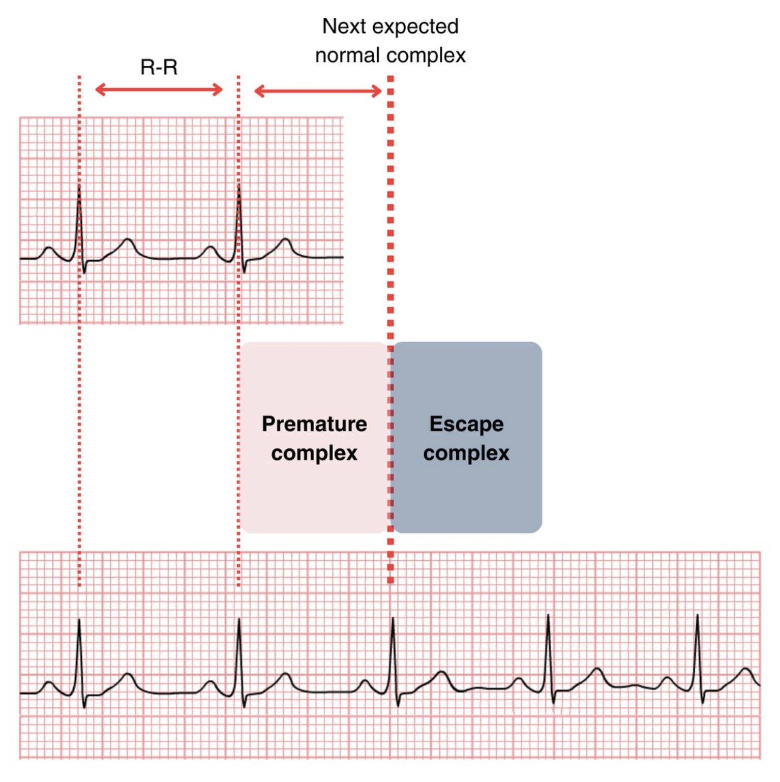 Premature complexes: atrial vs junctional vs ventricular