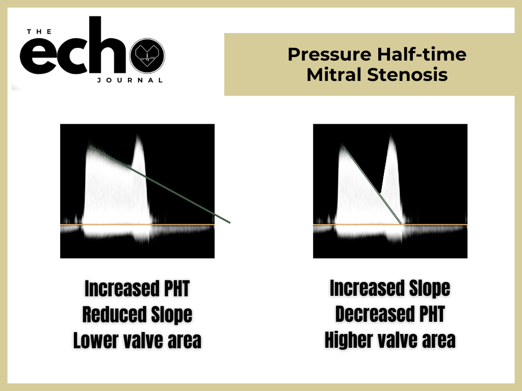 Aortic Regurgitation & Pressure Half-Time: The Tool You Should Know About