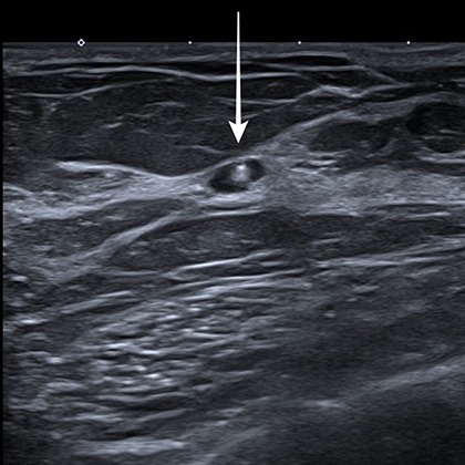 Titanium Markers in Breast Biopsies: Are They Safe and Do They Stay in ...