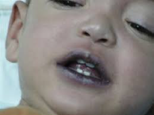 Pediatric Pearls: Infant's Skin Part 1 - Color Variations
