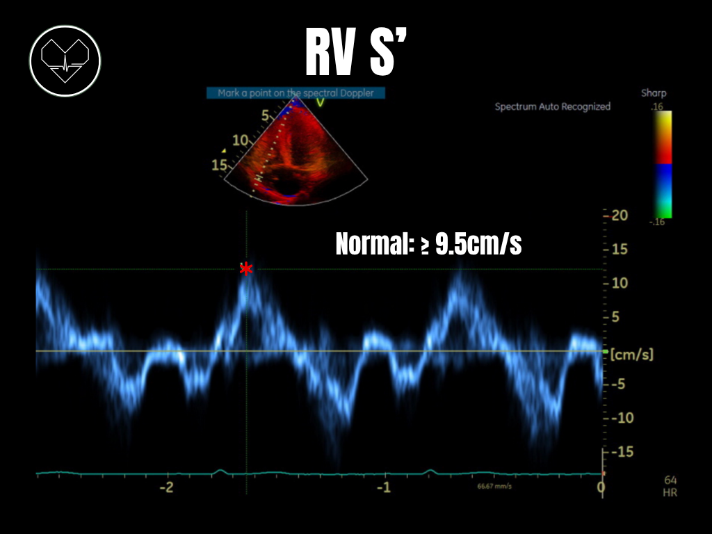Cor Pulmonale on Echo: What Sonographers Need to Know