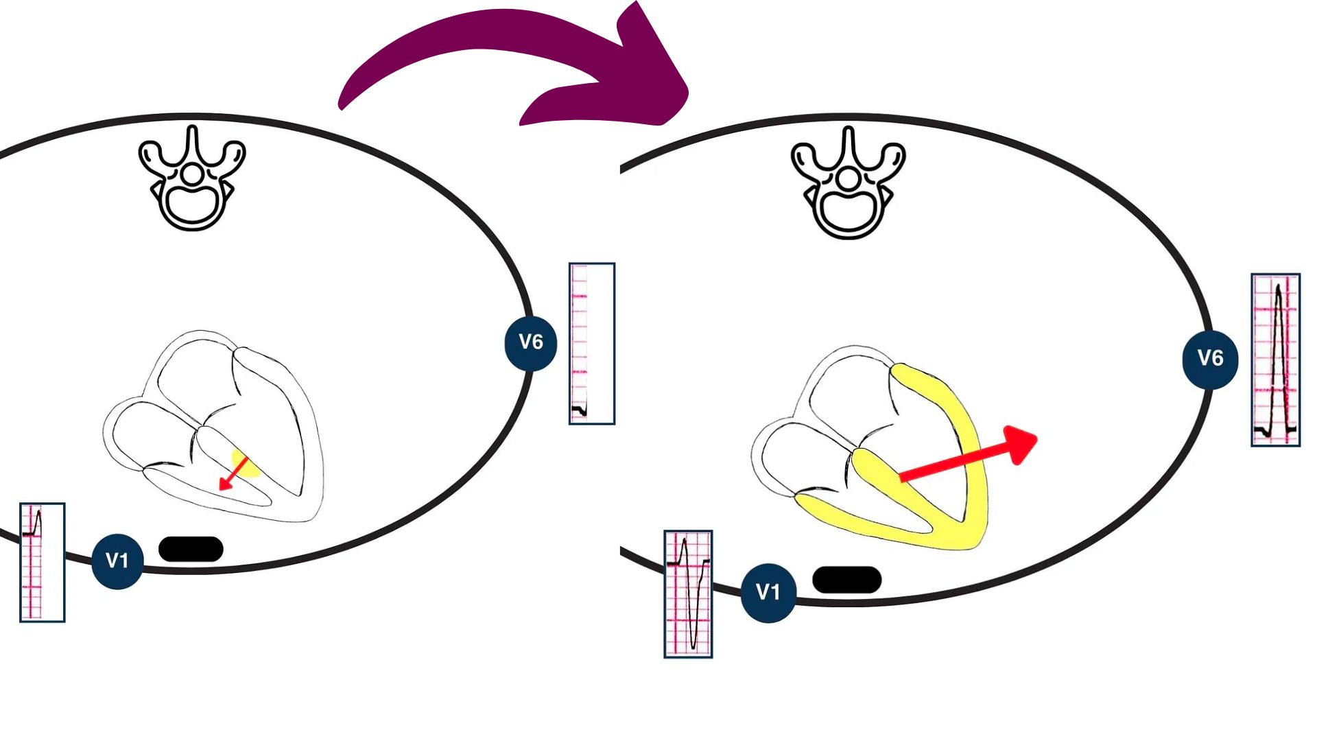 QRS complex nomenclature and morphology