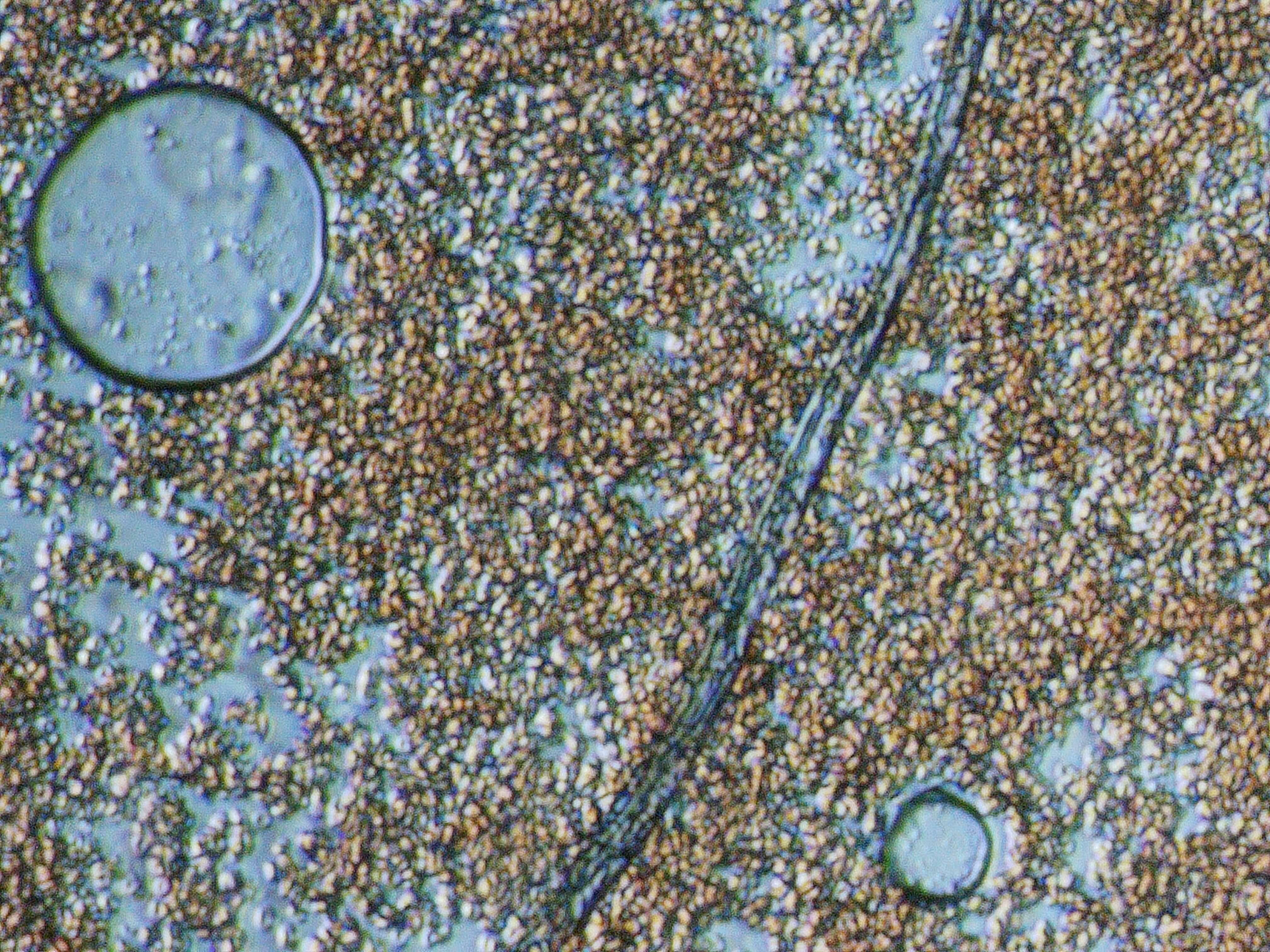Morgellons Like Filament Tumor Found In Nasal Cavity With Insect ...
