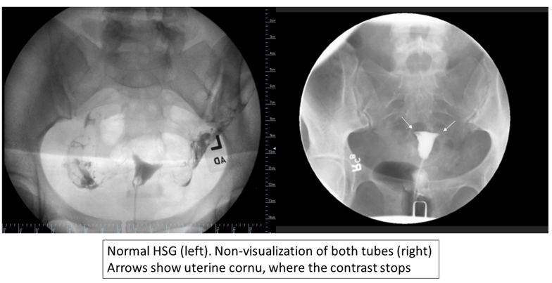 Non-visualization of Fallopian tube in HSG - by Dr. Huang