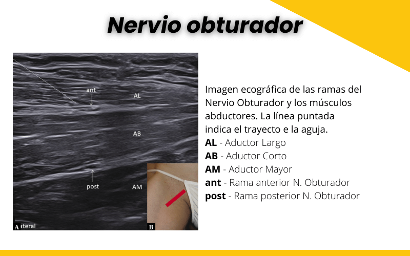 Nervio obturador y ecografía - by Tempo Formación