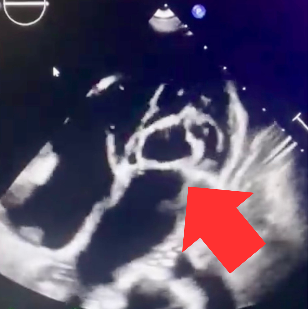 What is a Parachute Mitral Valve? - by Aram K.