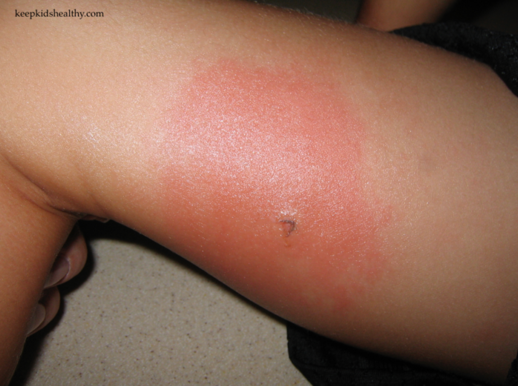 What to Do for Huge Bug Bites - by Natasha Burgert, MD