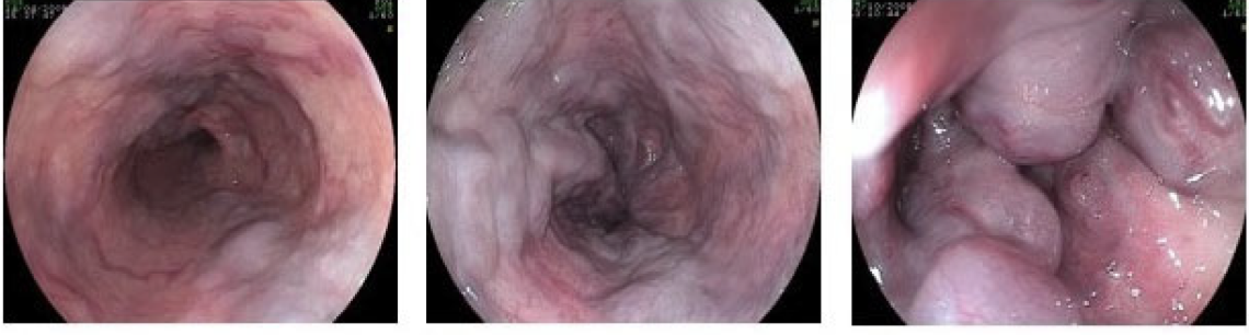 3 warning signs of Advanced Liver Disease - Dr Arif Hussenbux