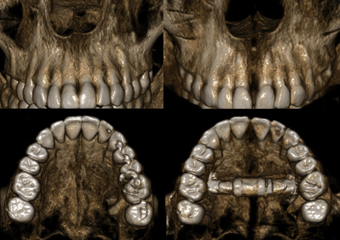 5.4 MARPE Surgical Assists - From Least to Most Invasive
