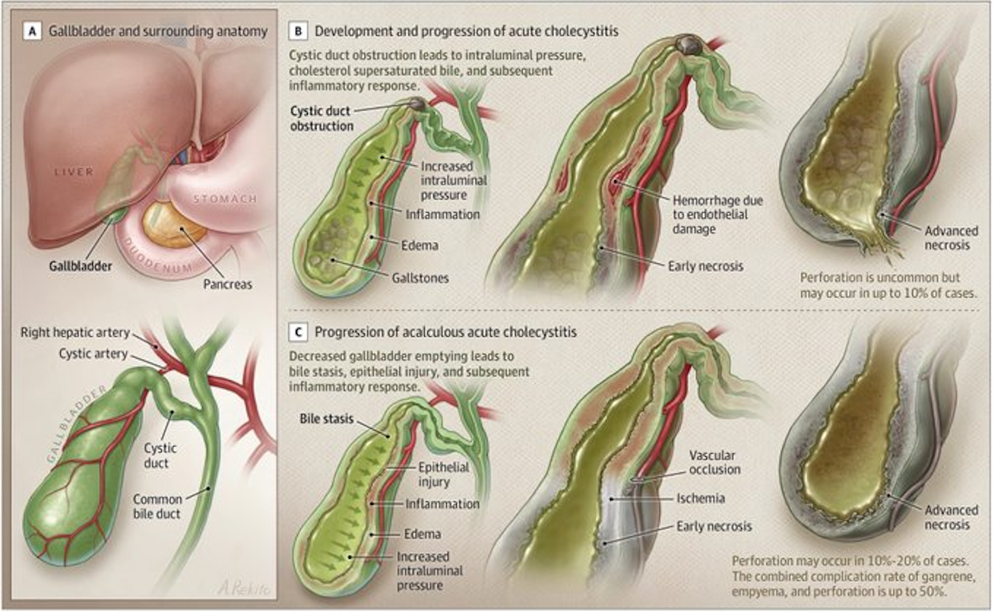 Acute Cholecystitis - Nice Review of Pathophysiology and Clinical Approach
