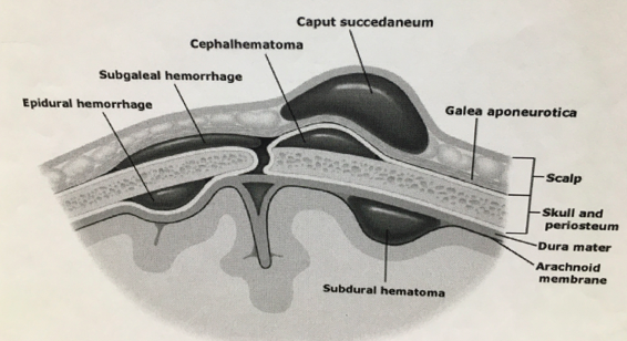 Pediatric Pearls: Infant's Head - Bumps, Lumps and Soft Spots