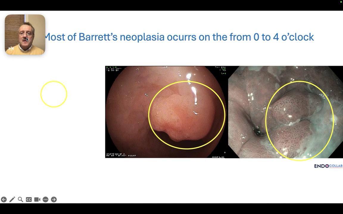 Barrett's Esophagus - Prague Classification - EndoCollab