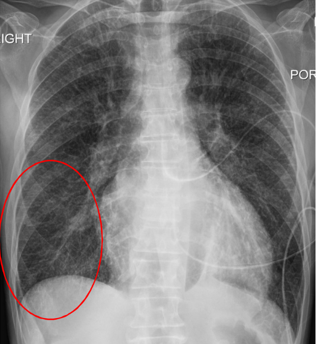 Como avaliar congestão pulmonar?