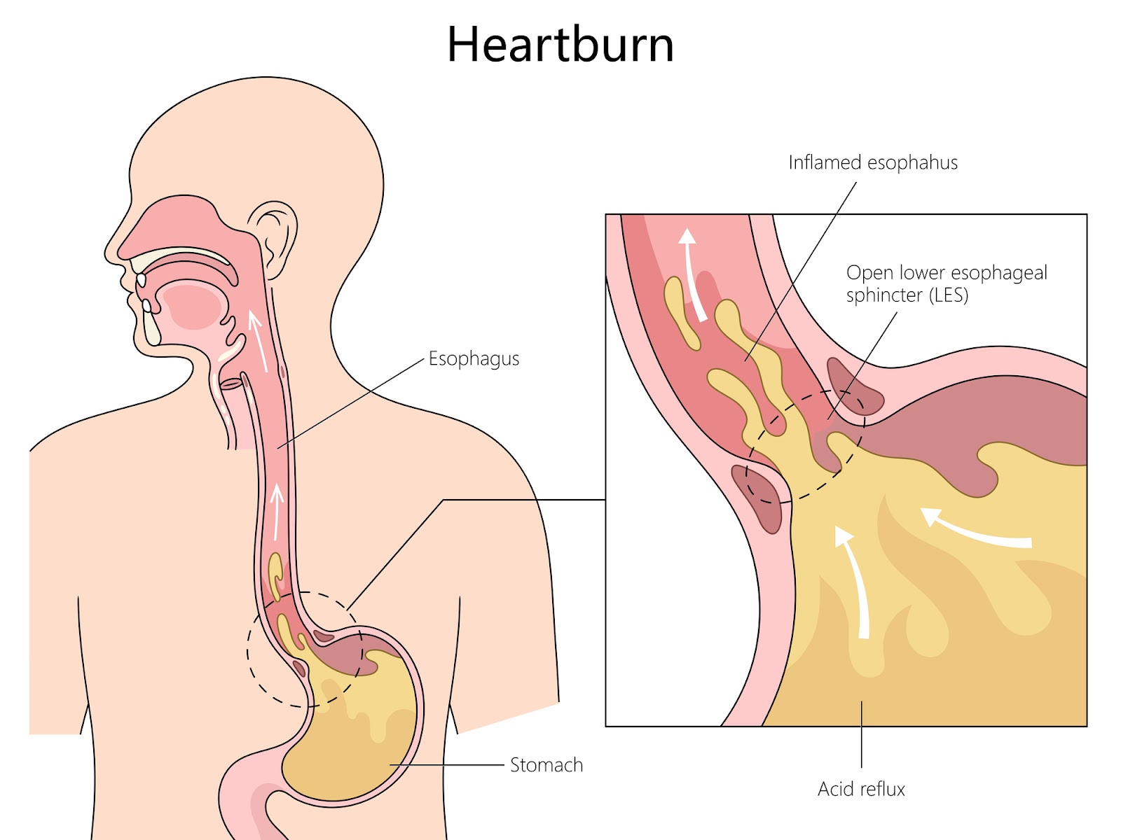 Heartburn, Reframed: How Posture, Diet, and Gut Health Influence Acid ...
