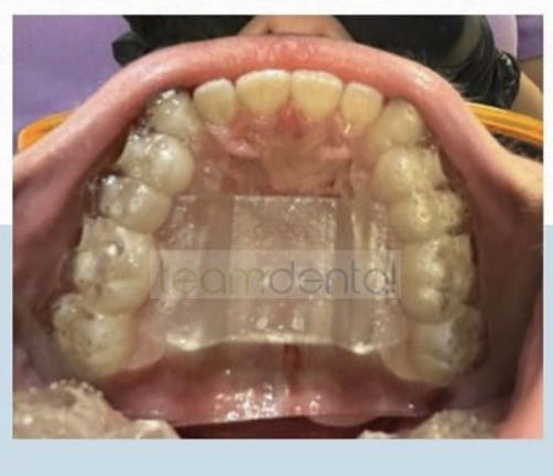 5.3 Top MARPE Devices Currently Available - JawHacks