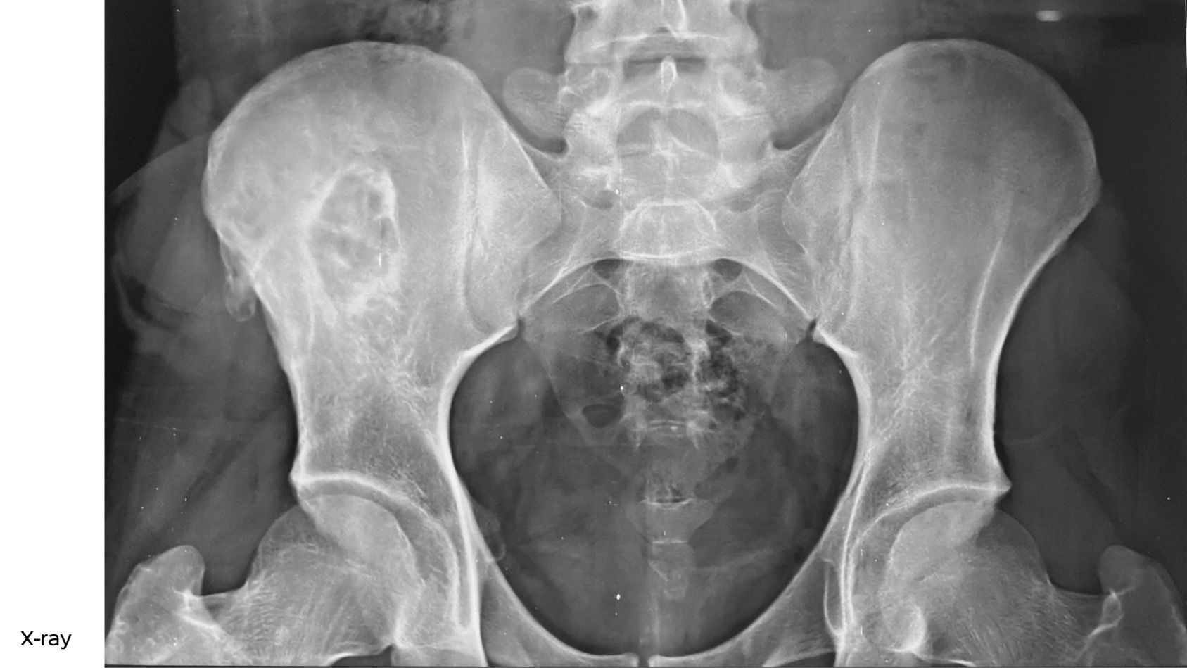 Case 35: The Iliac Overhang - by Bhavin Jankharia