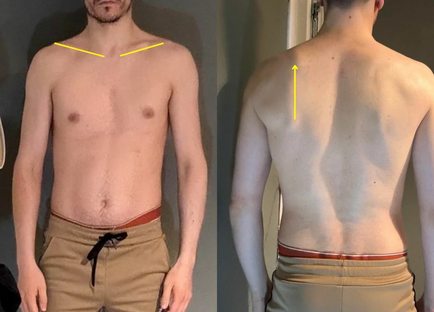 How To Fix Uneven Shoulders - Posturepro