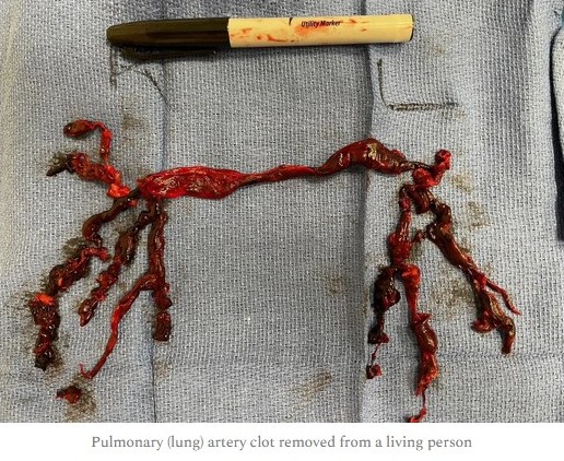 White clots - Overview - by Vesa Vanhatupa - Vesa reports