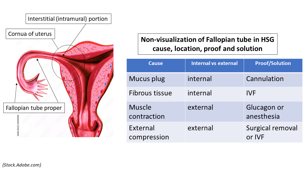 Non-visualization of Fallopian tube in HSG - by Dr. Huang