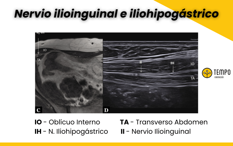 Nervio ilioinguinal e iliohipogástrico - by Tempo Formación