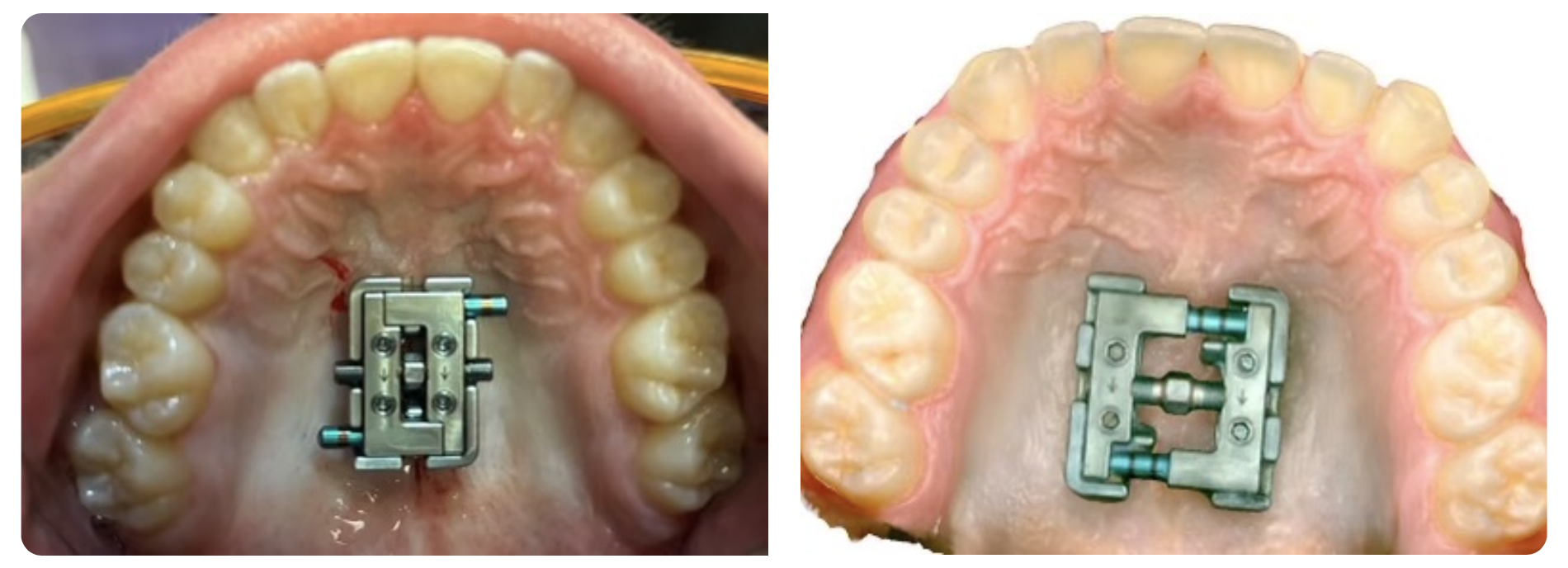Part 2 - Dr. Newaz on FME vs. Custom MARPE - JawHacks