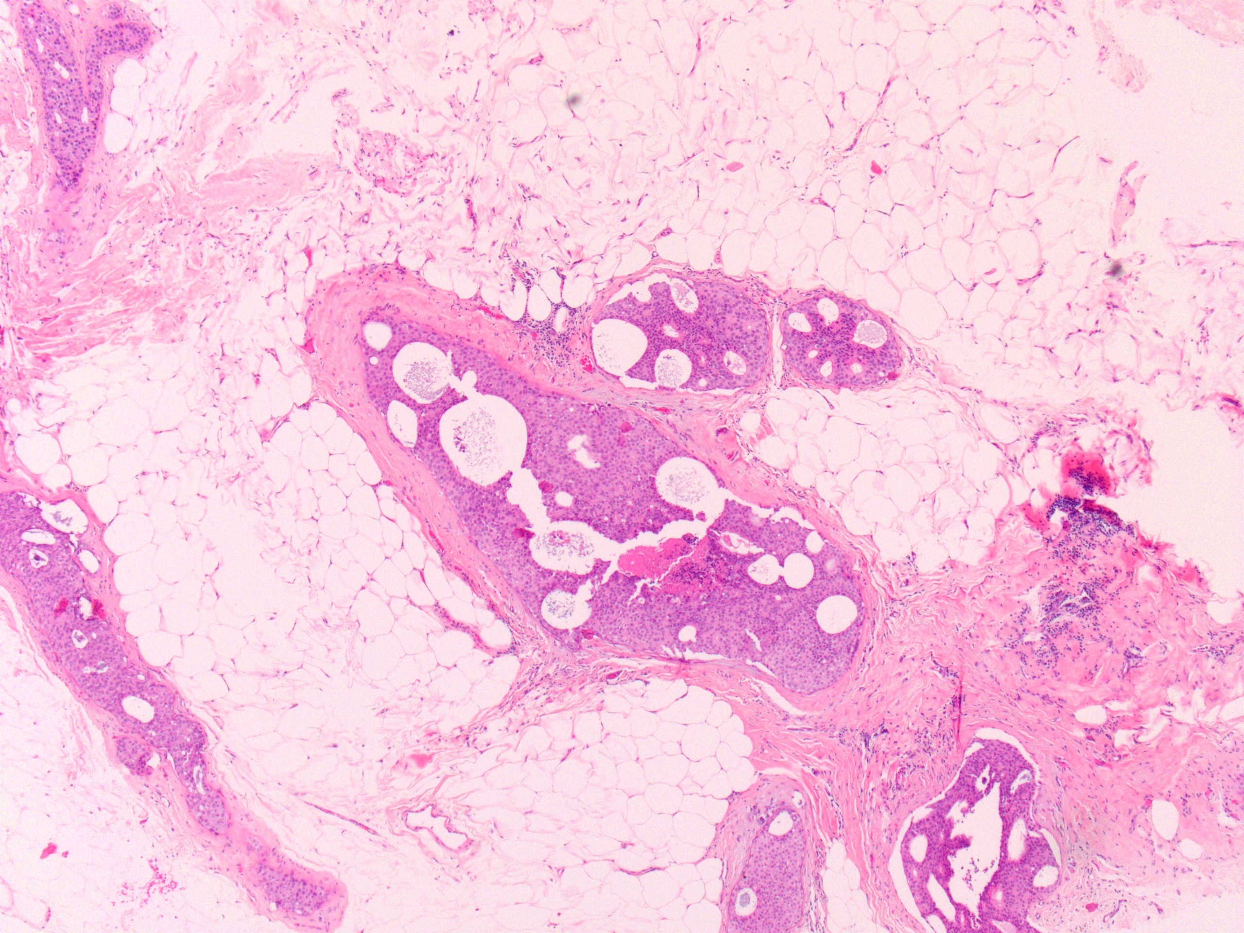 Ductal Carcinoma in Situ (DCIS) - by Chelsea Mehr, MD