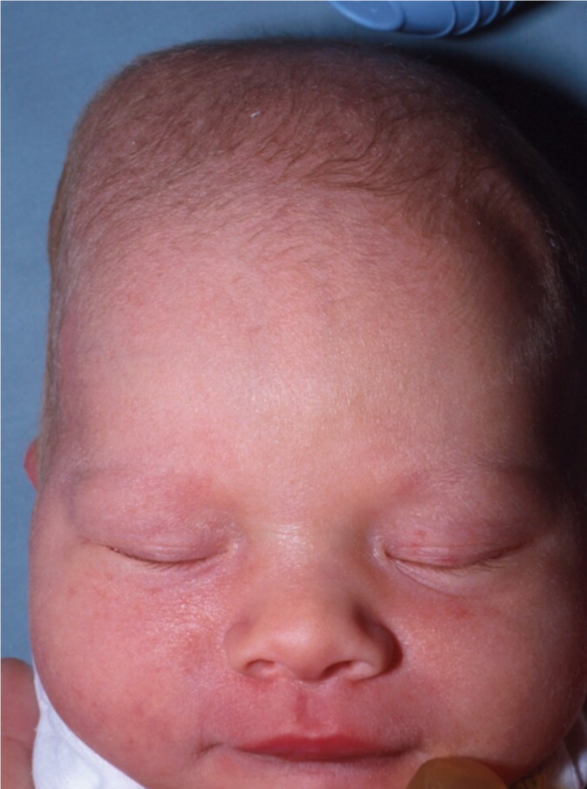 Pediatric Pearls Infant s Head Bumps Lumps And Soft Spots pediatric-pearls-infant-s-head-bumps-lumps-and-soft-spots