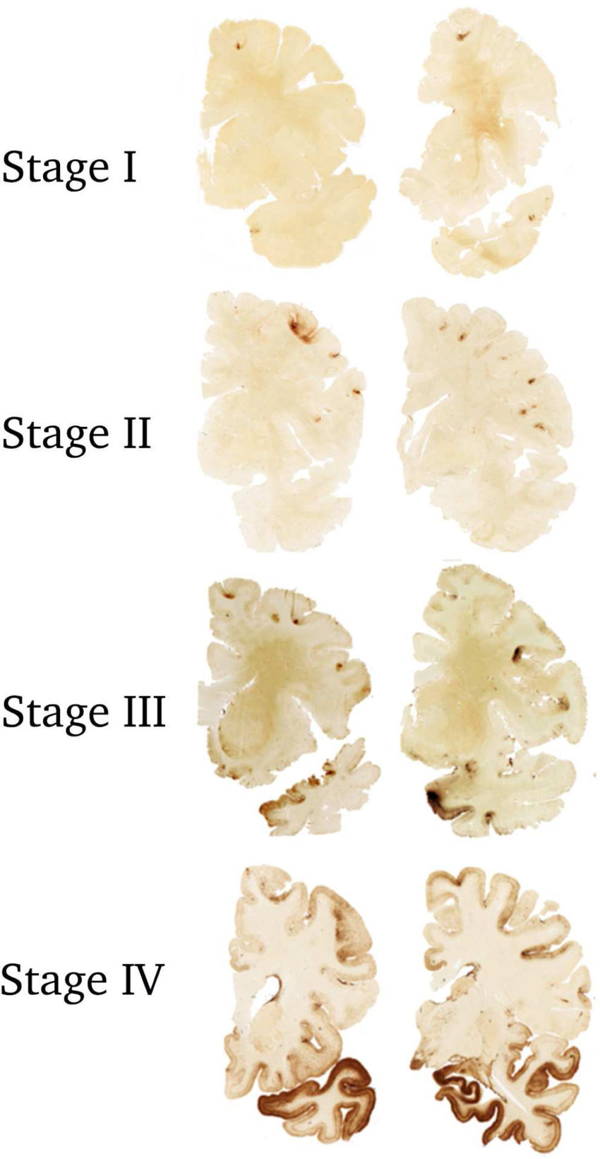 CTE in Athletes: A Study of Brain Injuries