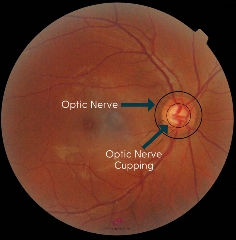 Narrow Angle Glaucoma: Causes, Symptoms, and Treatments