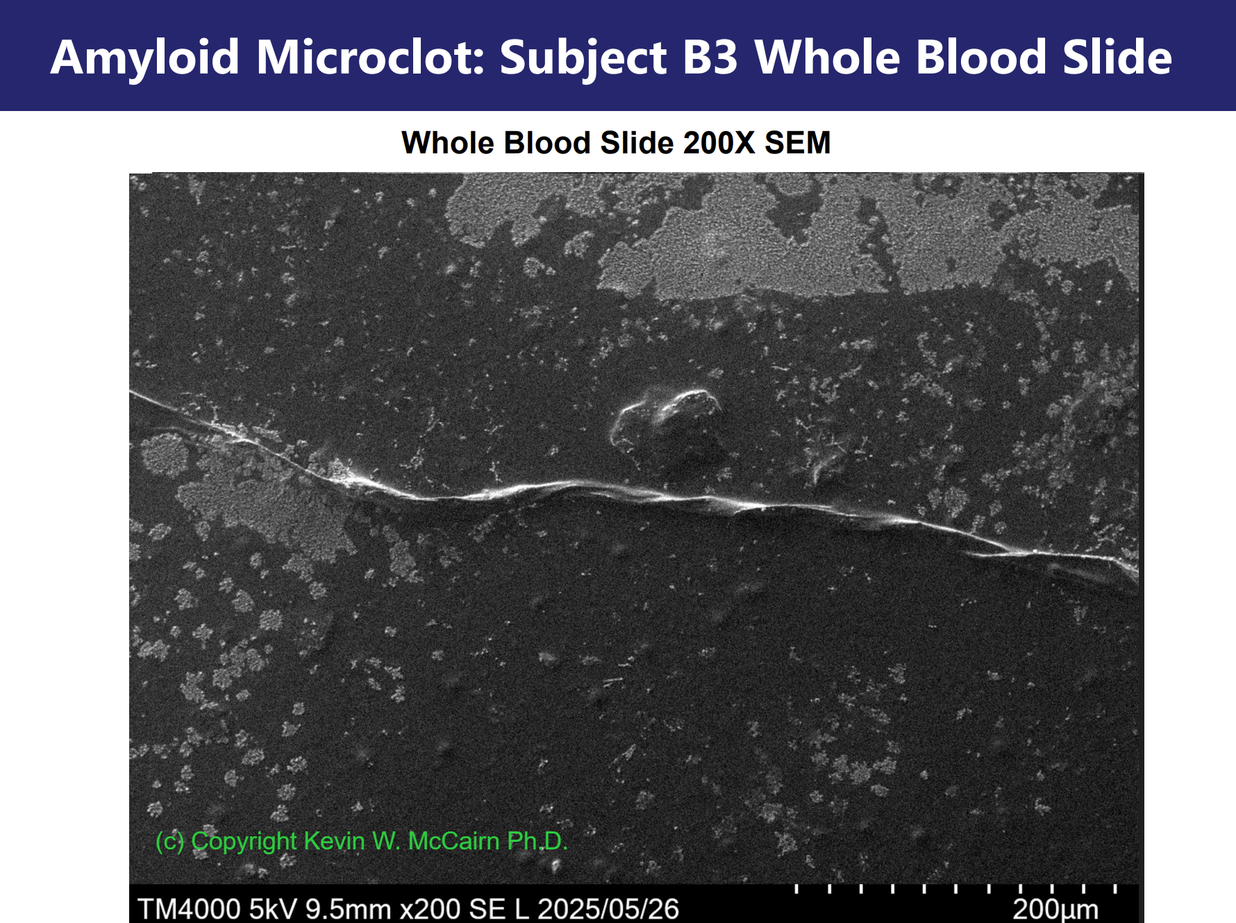 BREAKING: Prion-Like Amyloid Fibrils Found in 3-Year-Old Born Lifeless ...