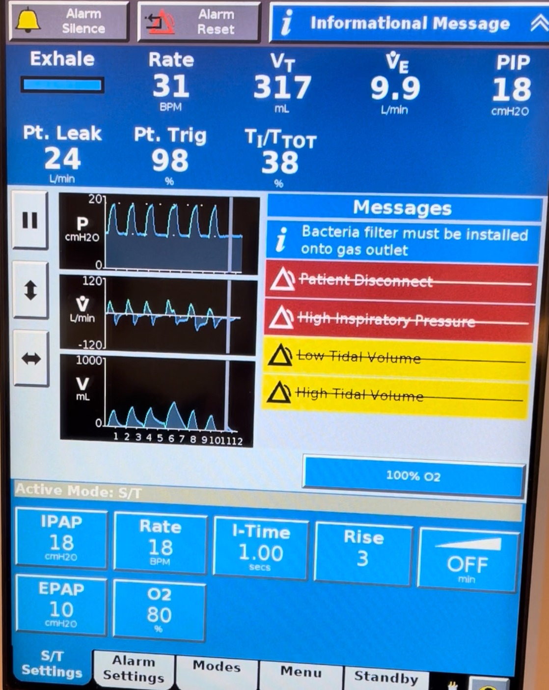 CPAP, BiPAP, AVAPS, HFNC – Which One Does Your Patient Need?
