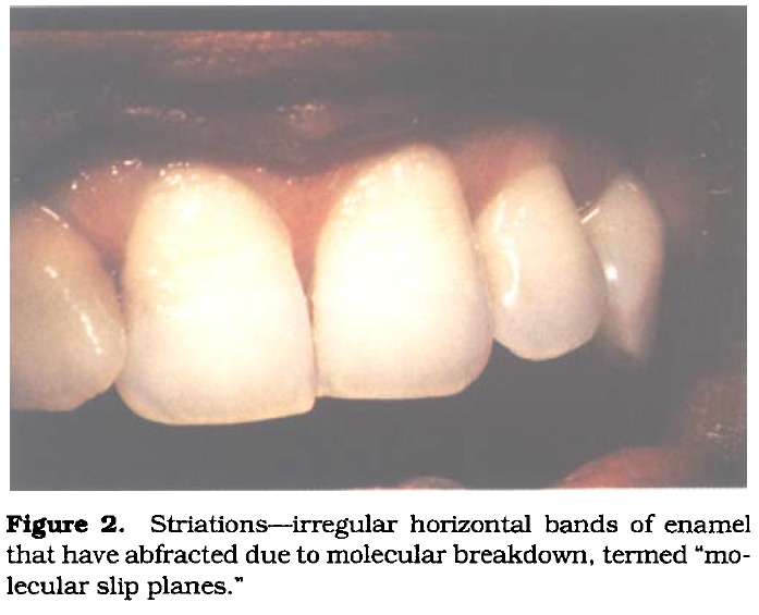 Abfractions: A New Classification of Hard Tissue Lesions of Teeth