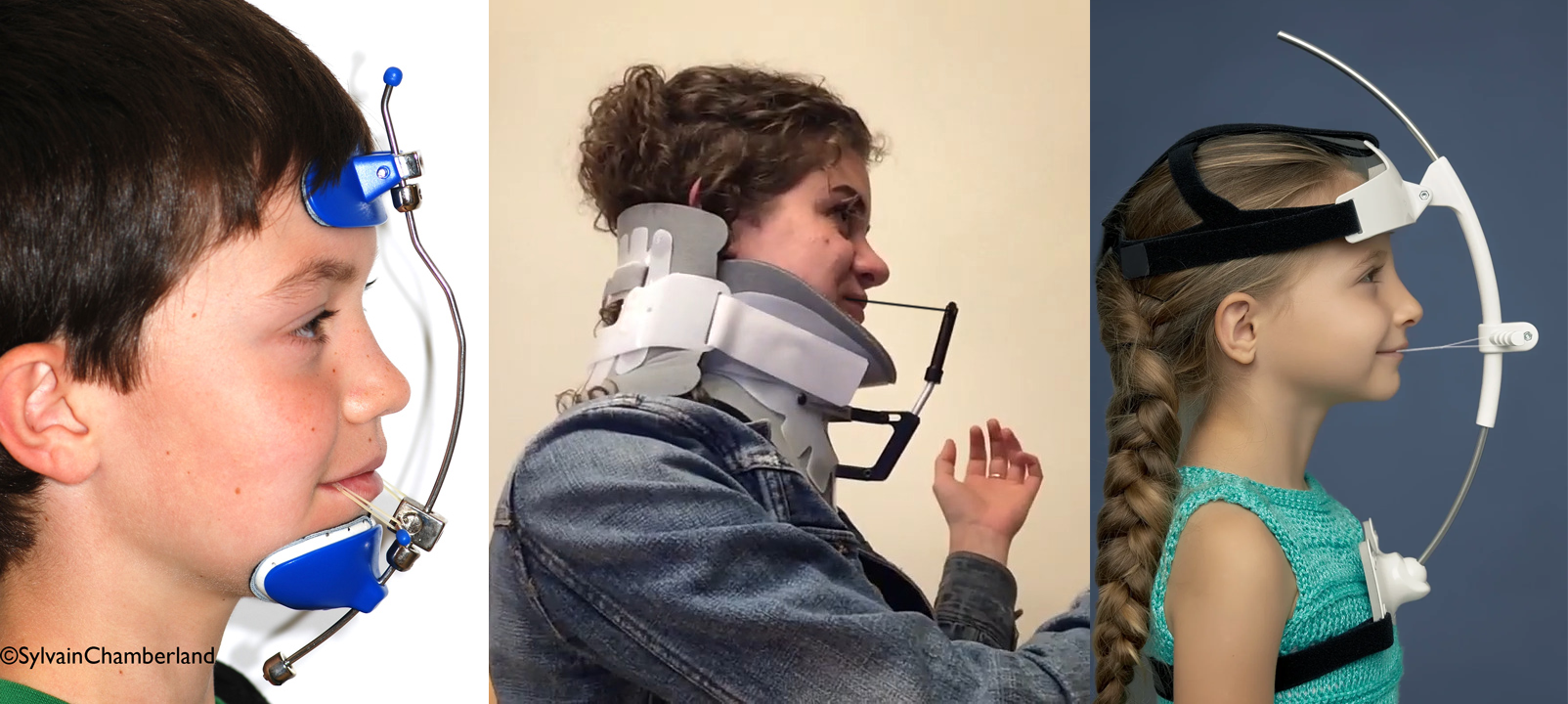 7.6 MARPE + Facemask for Protraction - by Ronald Ead