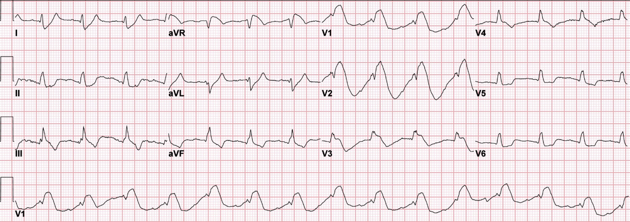 Hyperkalemia-induced EKG changes - by Maher Alrahamneh, MD