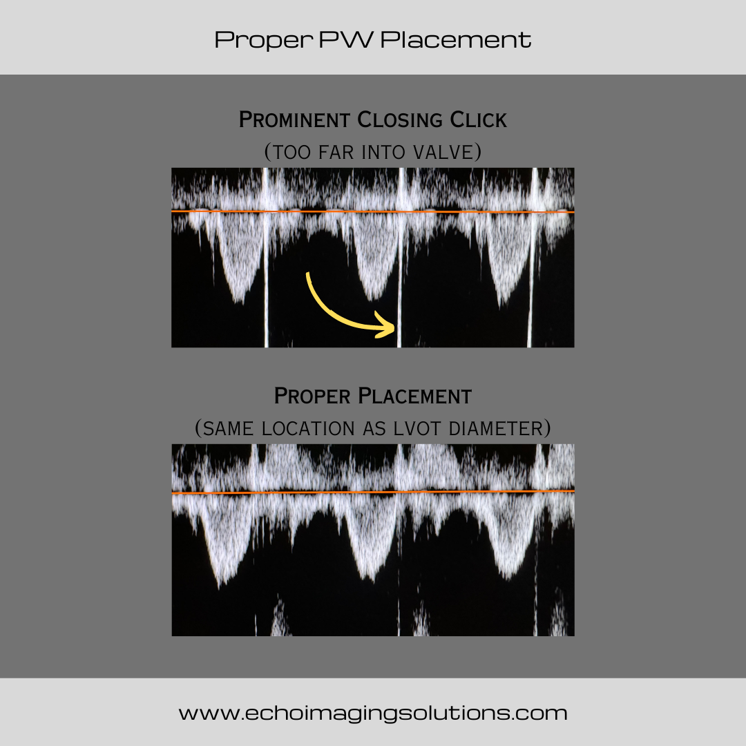 Aortic Stenosis: The Perfect TTE - by Aram K.