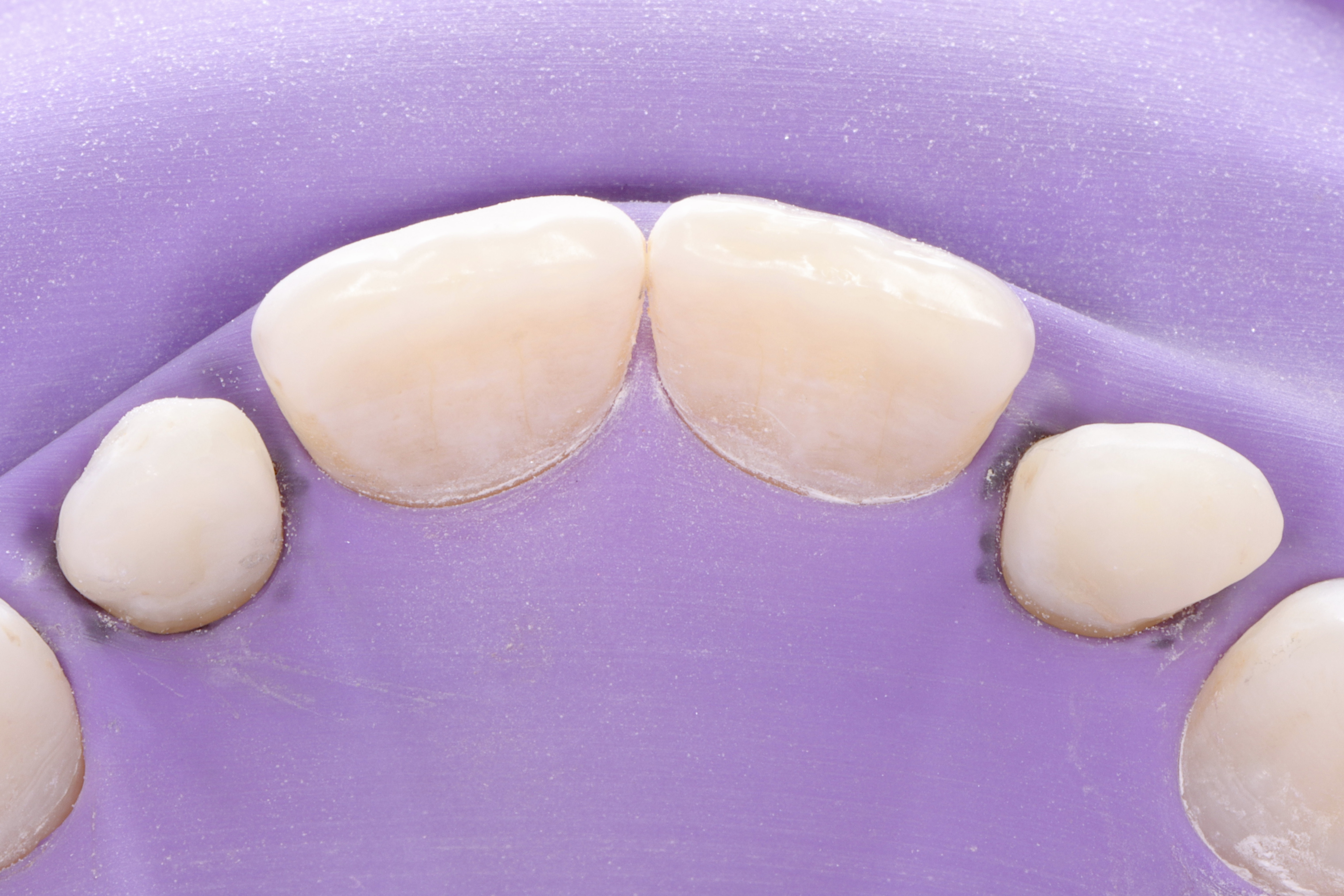 Peg Lateral Rejuvenation - by Brandon Walker, D.D.S.