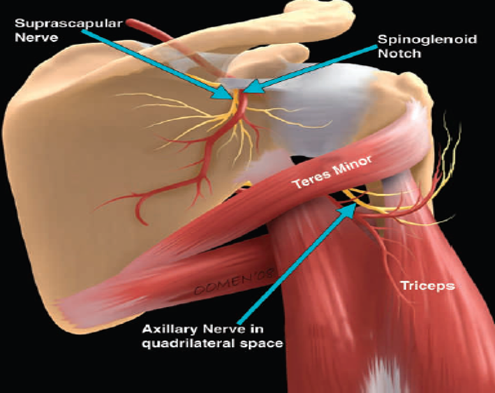 Neuropatia do supra-escapular - Causas, sitios de compressão e casos ...