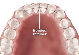 Permanent Retainers Are Causing More Problems Than You Think