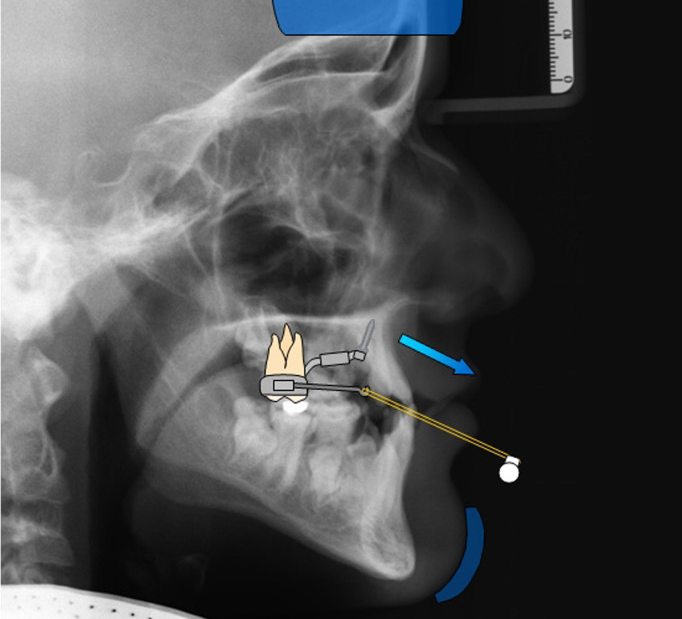 7.6 MARPE + Facemask for Protraction - by Ronald Ead