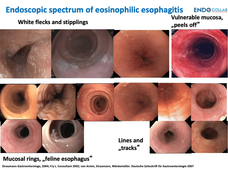 EREFS Score for Eosinophilic Esophagitis (EoE)