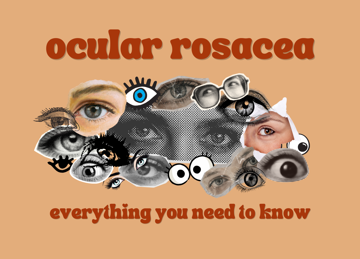 Ocular Rosacea: Everything You Need To Know