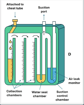 Chest Tubes & Pigtails: 5 Must-Know Tips for ICU Rotation
