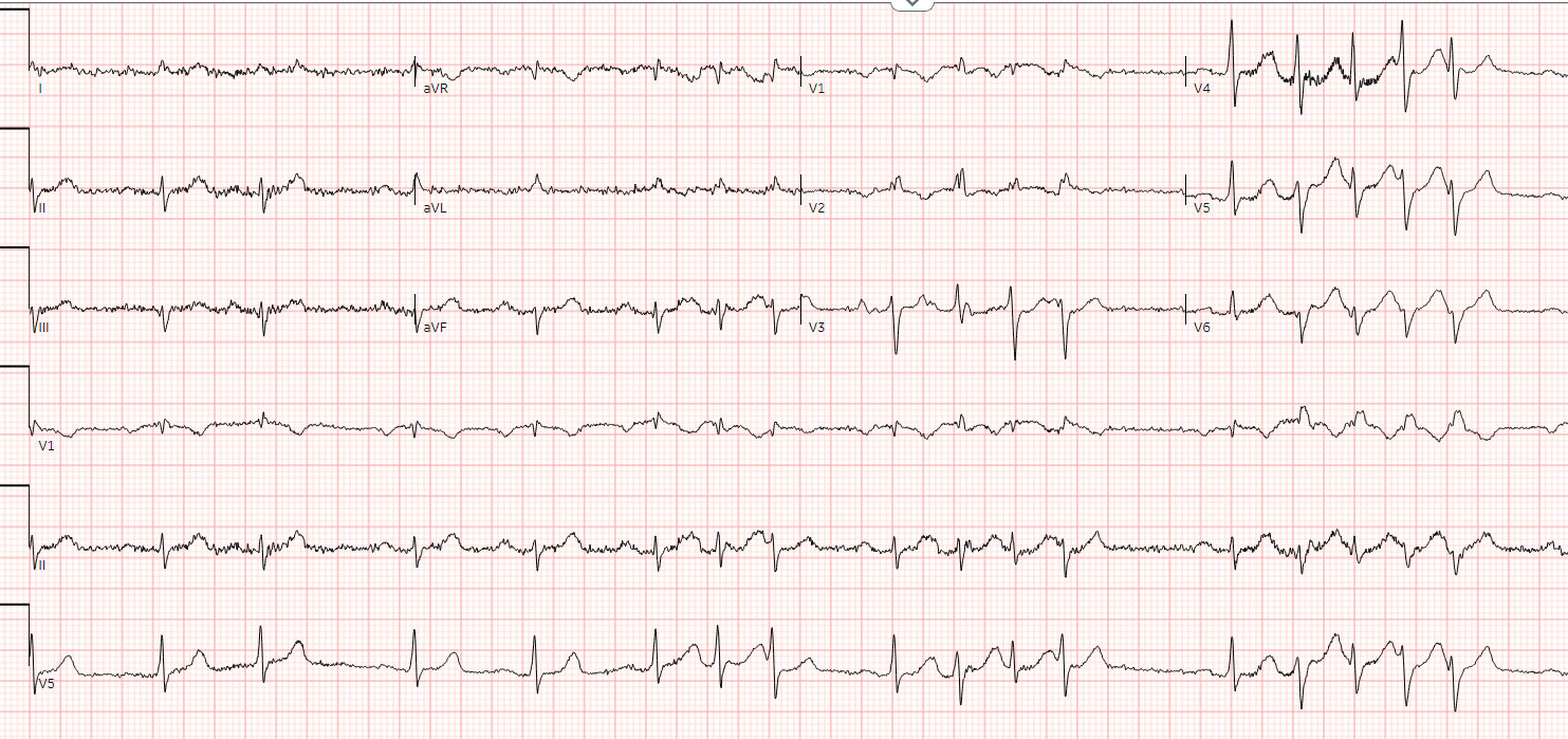 Know the 3 Causes of Irregularly Irregular Rhythms