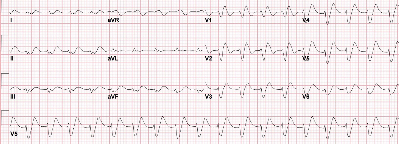 Hyperkalemia-induced EKG changes - by Maher Alrahamneh, MD