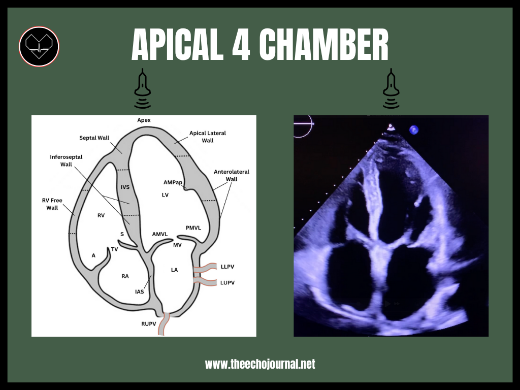 Apical 4 and 5: Technique, Landmarks, and Optimization