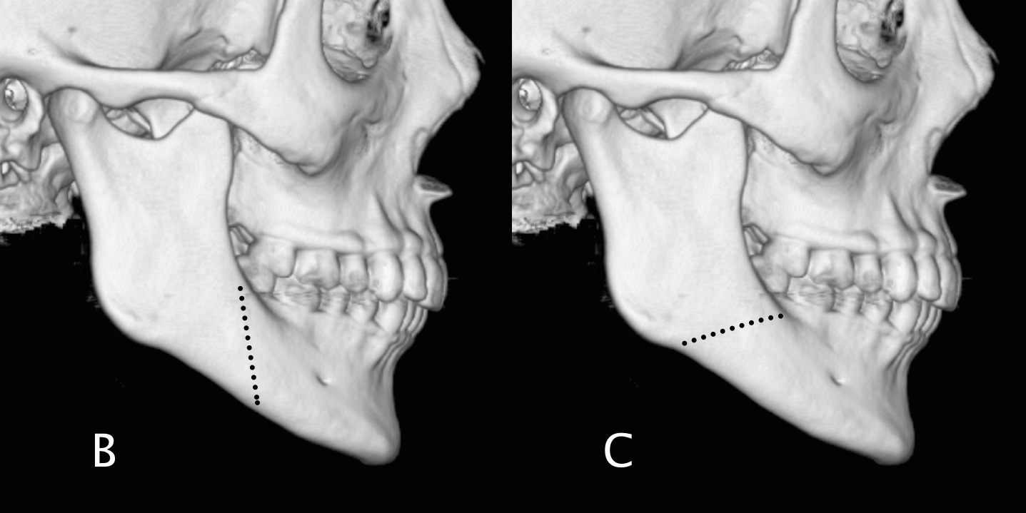 Mandible fracture - by Alexander Baxter - RadNotes