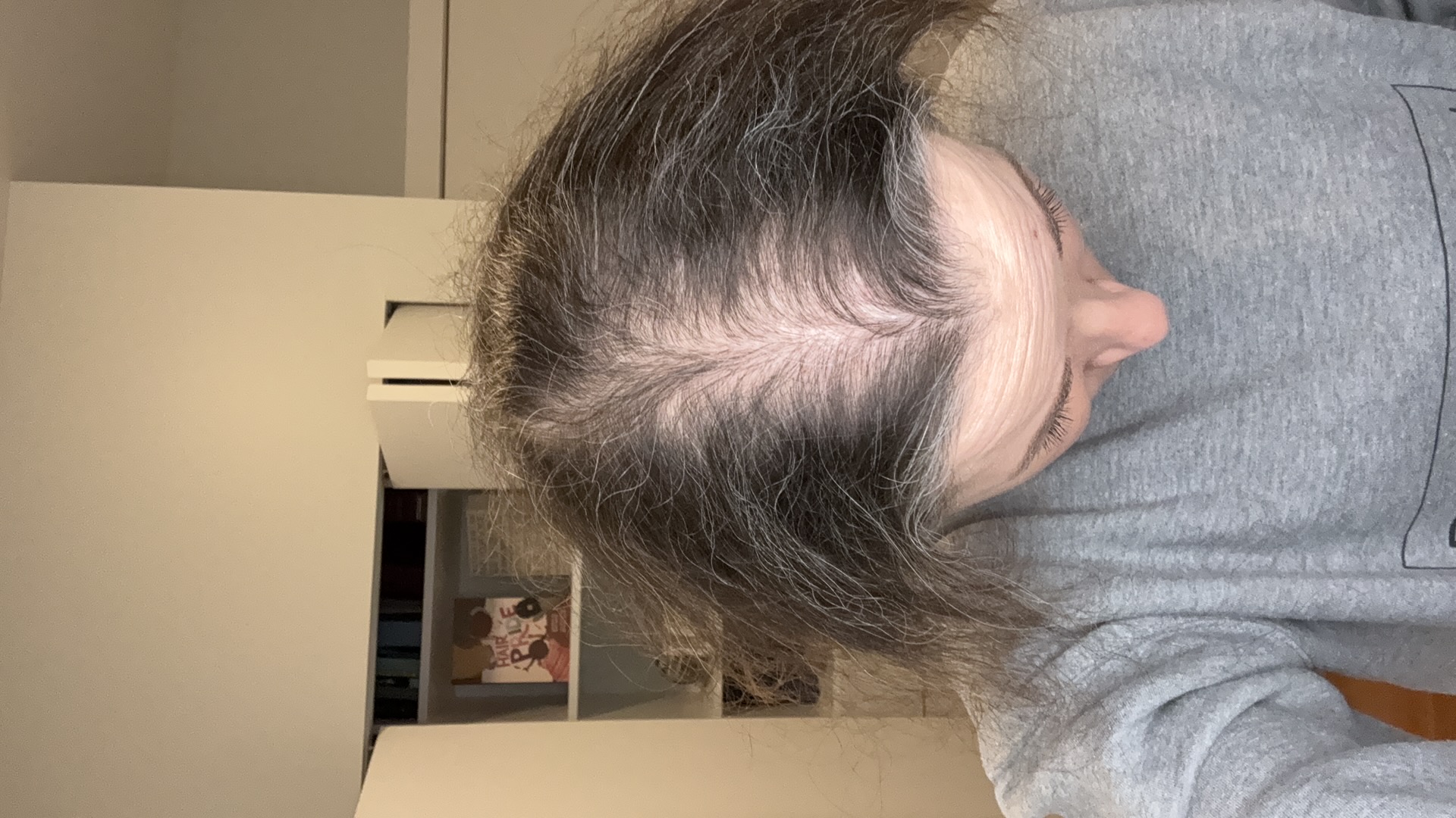 Androgenic Alopecia vs. Telogen Effluvium: - by Tami Wong