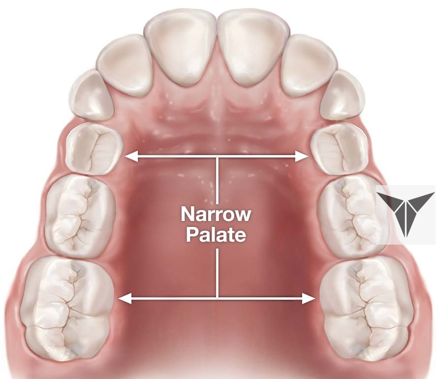 Strengthen your jaw, improve tongue posture, and fix facial imbalance ...