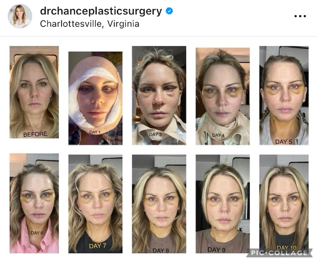 The Insta-Famous Facelift - by Jolene Edgar